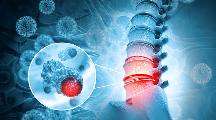 Metástase Óssea: Sintomas, Diagnóstico e Tratamento